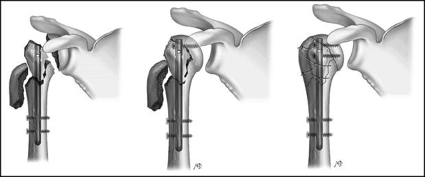Ostéosynthèse de l'Humérus à Bayonne : Guide Complet